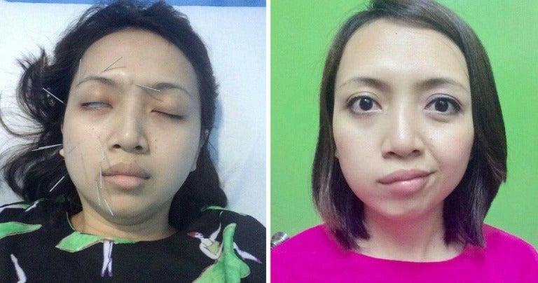 Malaysian Lady Shares Heartfelt Story On Why Her Face Was Drooping On ...