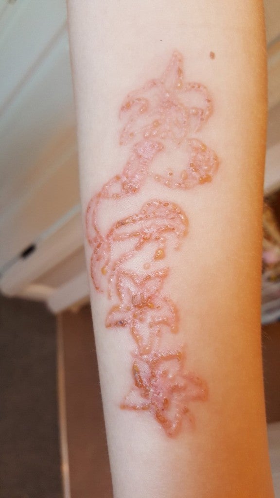 M'sian Shares Horrific Experience Getting Henna Tattoo That Caused ...