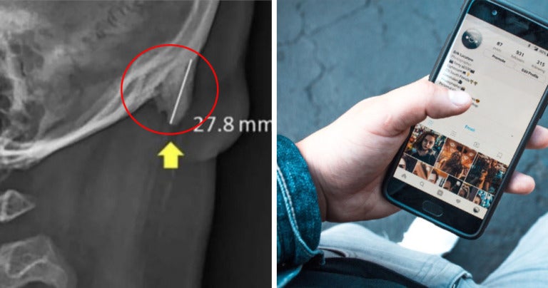 Research: Young People are Growing Horns at the Back of Their Skulls ...