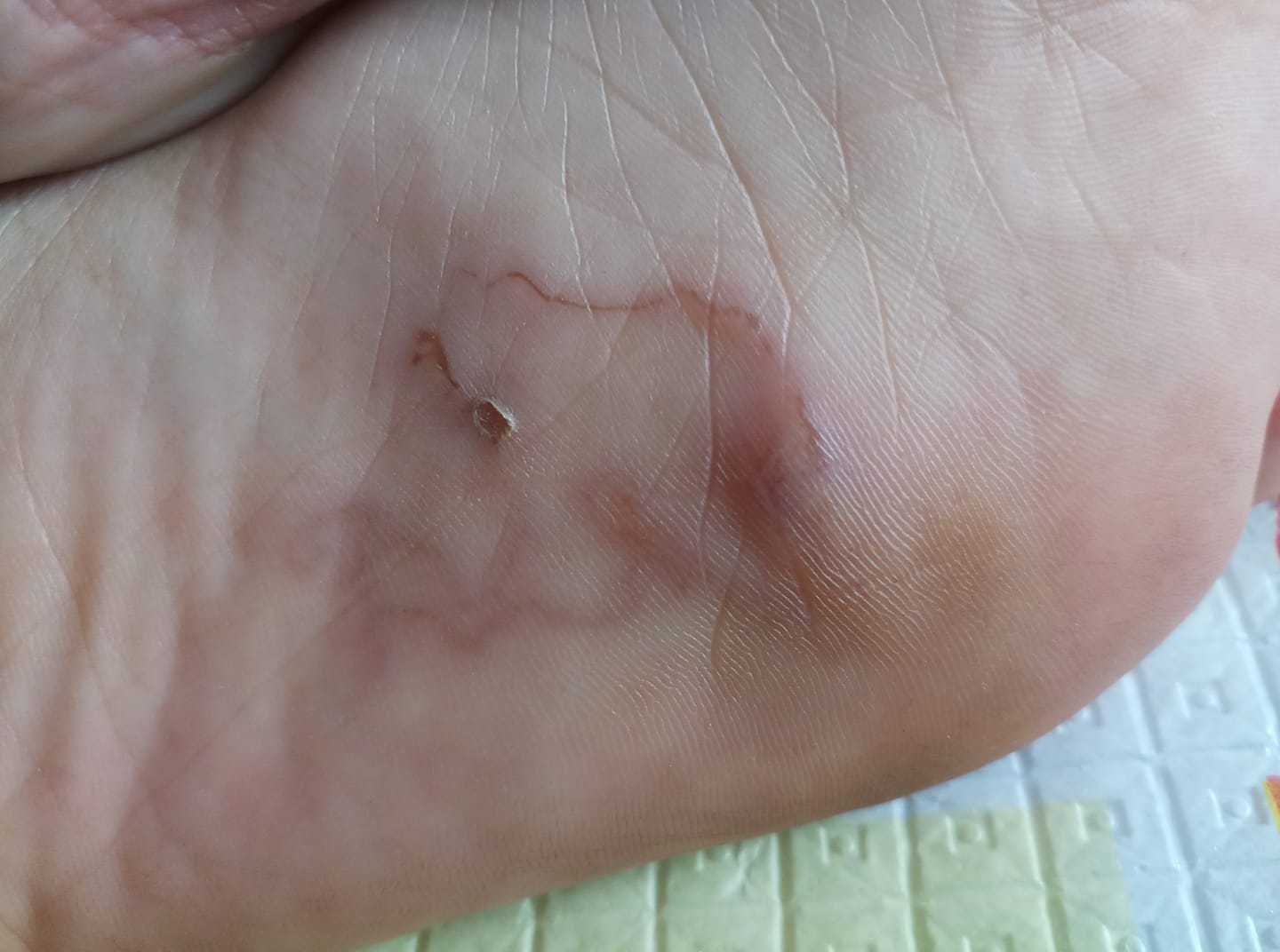 Malaysian Woman Gets Worm Infection in Her Foot After Family Vacation ...