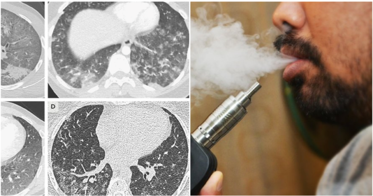 First Alleged Case Of Vape Related Illness Has Surfaced In Malaysia ...