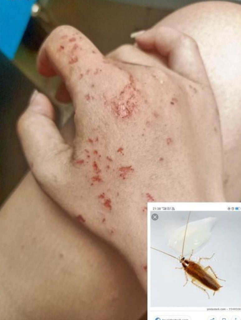 Woman's Hand Bitten by Cockroach While Sleeping, Most Likely Caused by ...