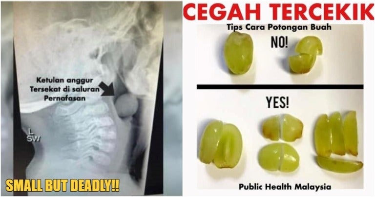 5-Year-Old Malaysian Rushed To The Hospital After Choking on a Tiny ...