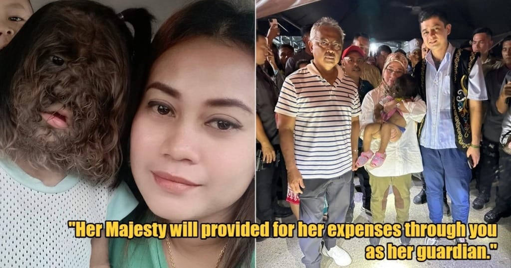 Queen 'Adopts' Sarawakian Girl With Werewolf Syndrome, Will Provide for ...