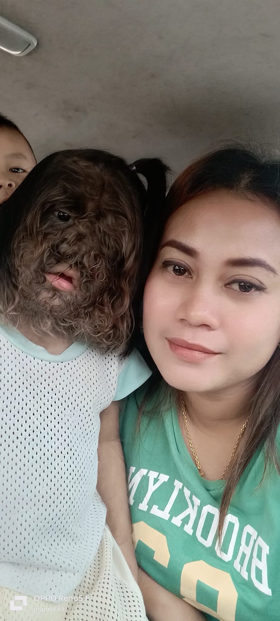 Queen 'Adopts' Sarawakian Girl With Werewolf Syndrome, Will Provide for ...