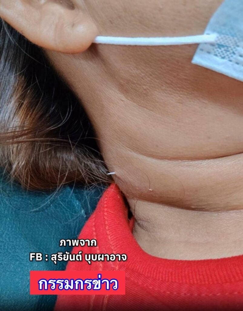 Thai Woman Gets 2cm Fishbone Stuck in Throat, It Ends Up Visibly ...
