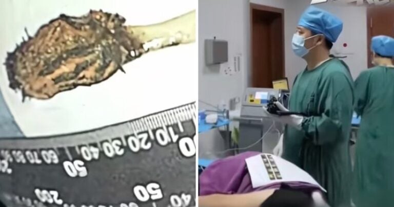 Chinese Man Suffering Stomach Ache Finds Out a Toothbrush Has Been ...